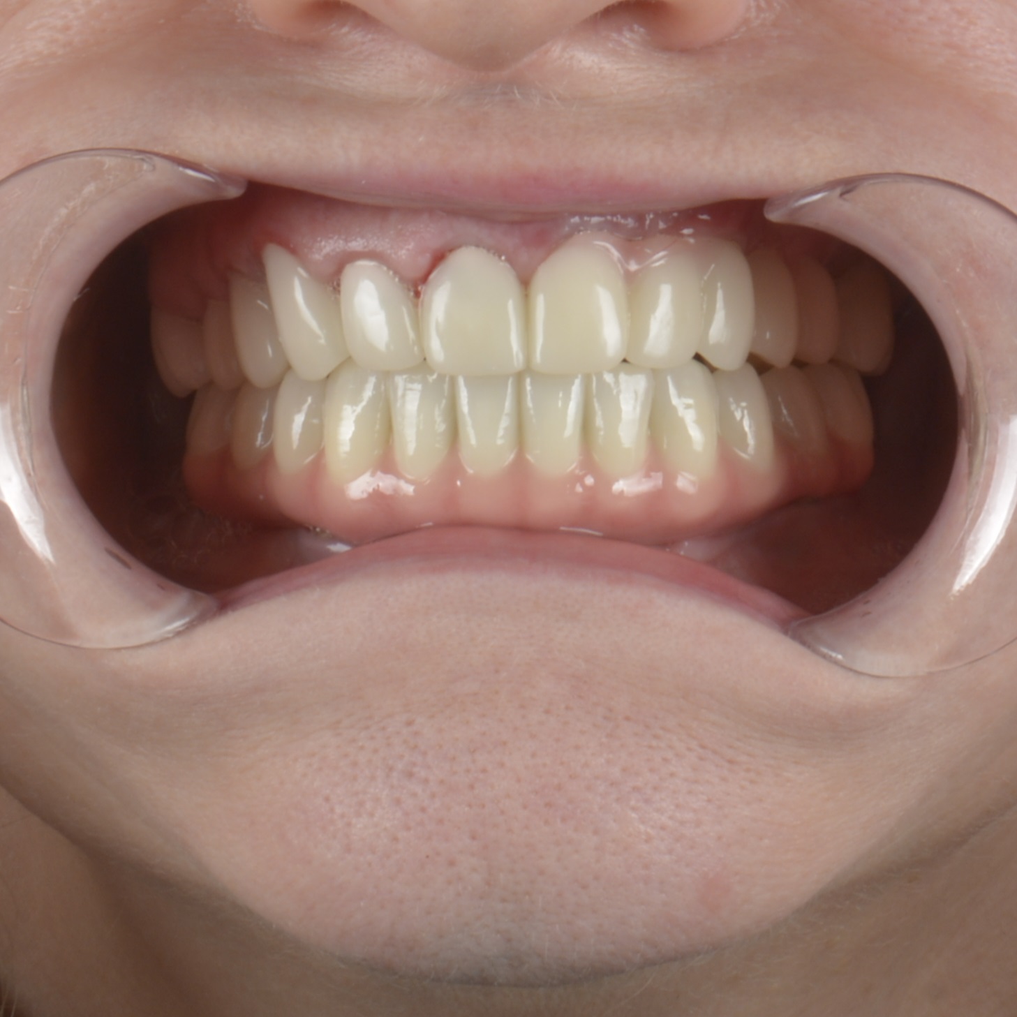 Робота наших лікарів: All-on-6, Імплантація Osstem, Гвинтова фіксація коронок - галерея Smile Lab