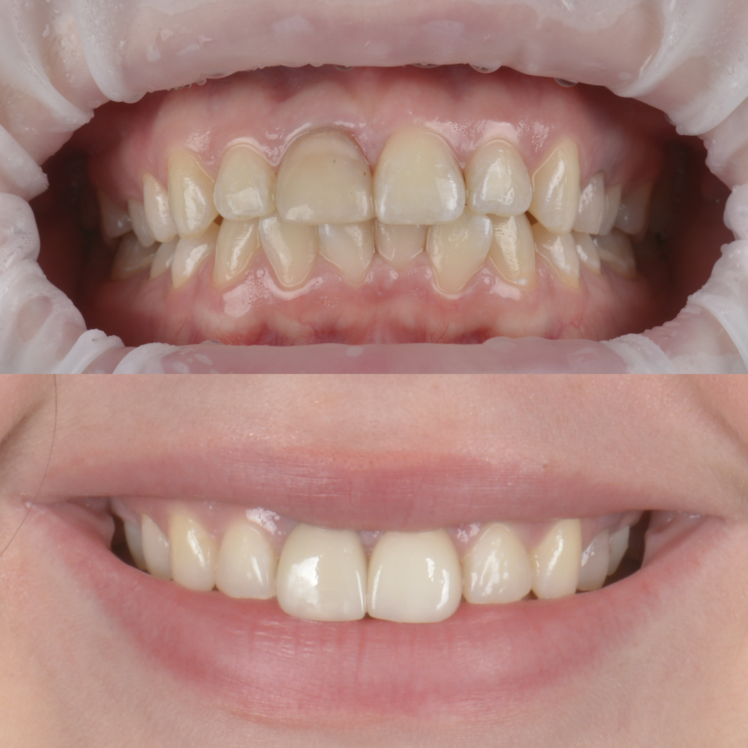 Робота з встановлення вінірів, лікар Зубков М. І - галерея Smile Lab