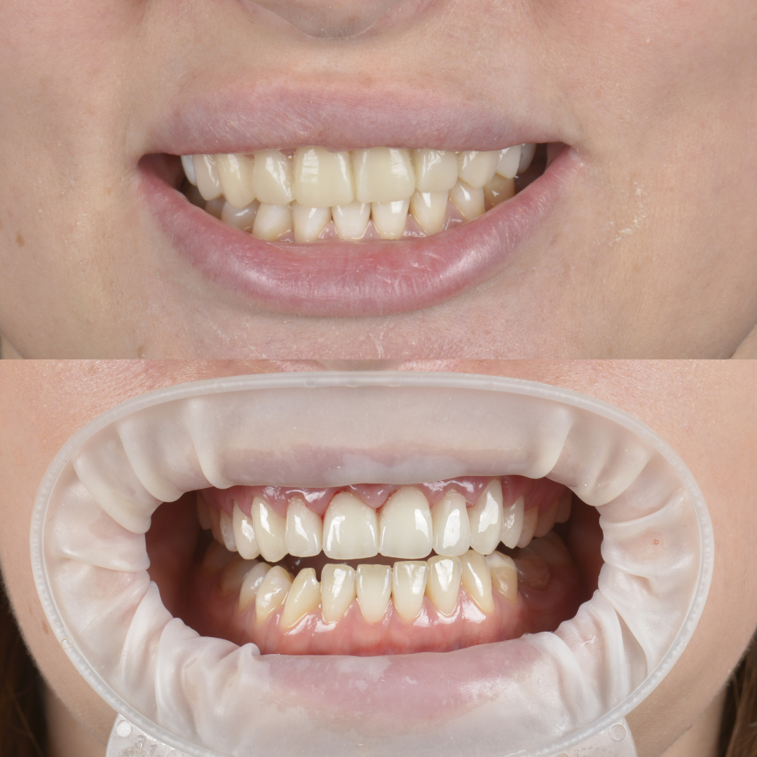 Робота наших лікарів: вініри, естетична стоматологія, лікар Зубков М. І - галерея Smile Lab