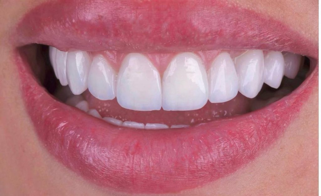 Робота наших лікарів по встановленню вінірів, лікар Зубков М. І - галерея Smile Lab